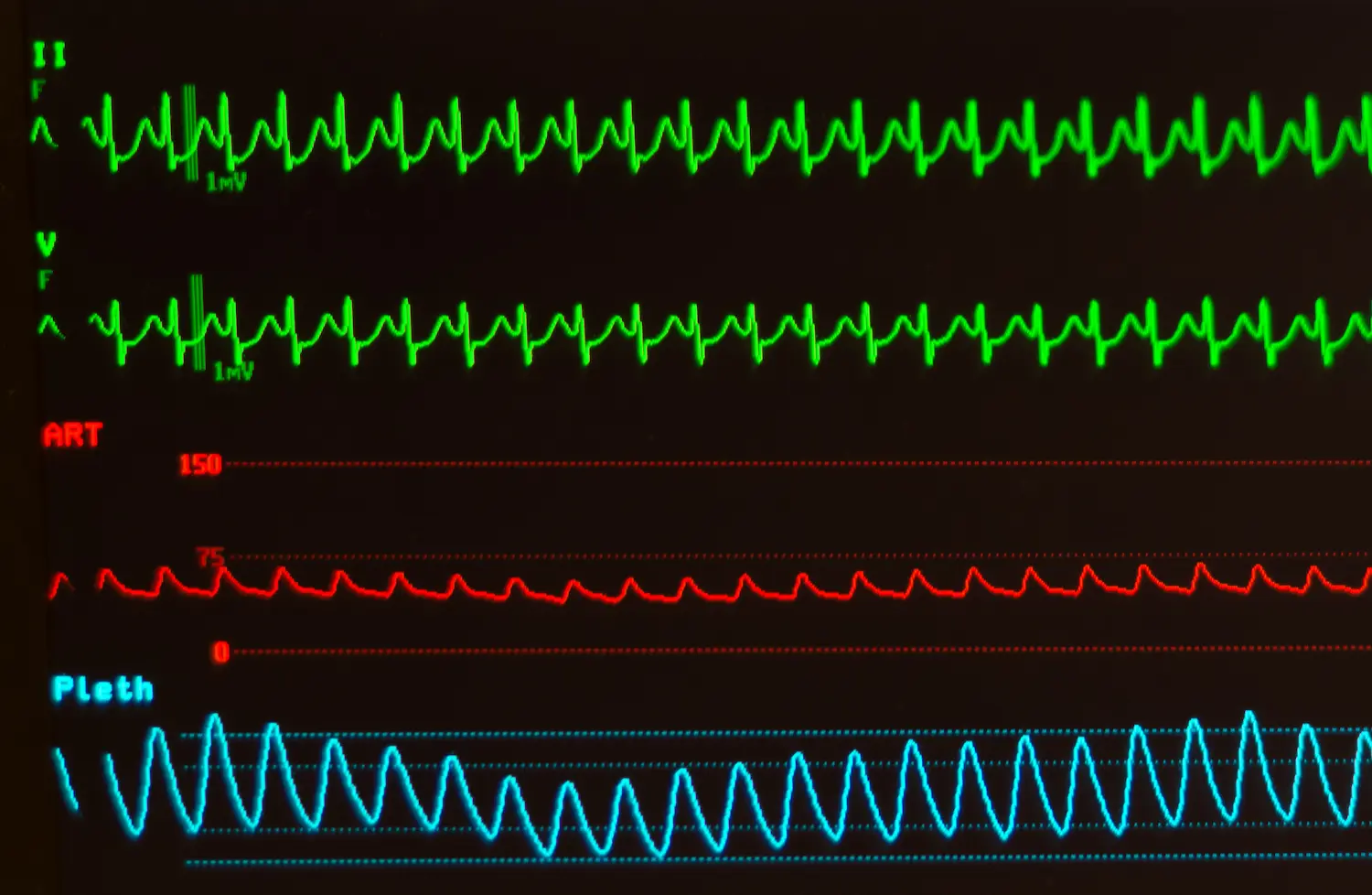 What is Tachycardia? | Symptoms, Causes & Treatment